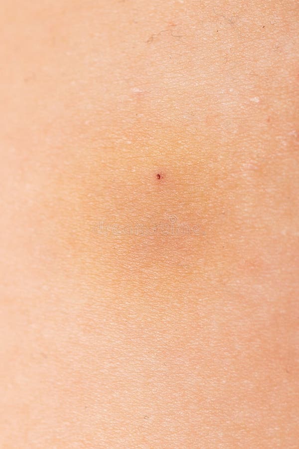 Een Kneuzing Op De Huid Van Een Mens Stock Afbeelding - Image of fysiek ...