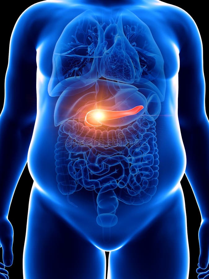 Alvleesklierkanker stock illustratie. Illustration of zwaarlijvig ...
