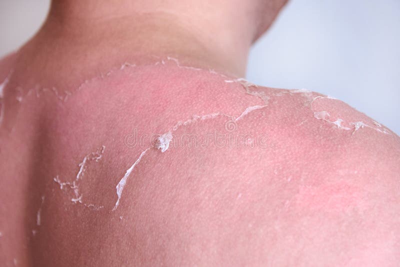 Effects of Sunburn on Human Skin, Close-up Stock Photo - Image of ...