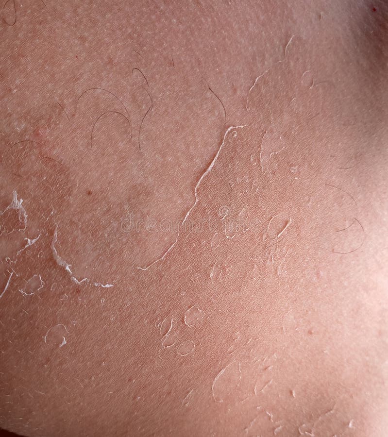 Effects of Sunburn on the Skin. Climb Skin Stock Image - Image of back ...