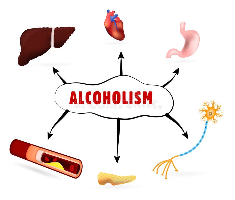 Effets Physiques D'alcoolisme Illustration de Vecteur - Illustration du ...