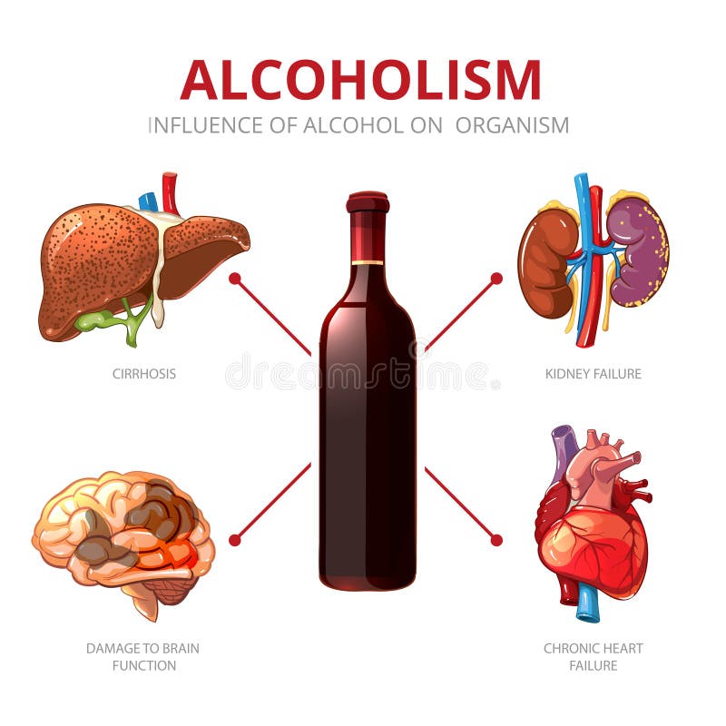 Effetti a Lungo Termine Di Alcool Vettore Di Alcolismo Illustrazione ...