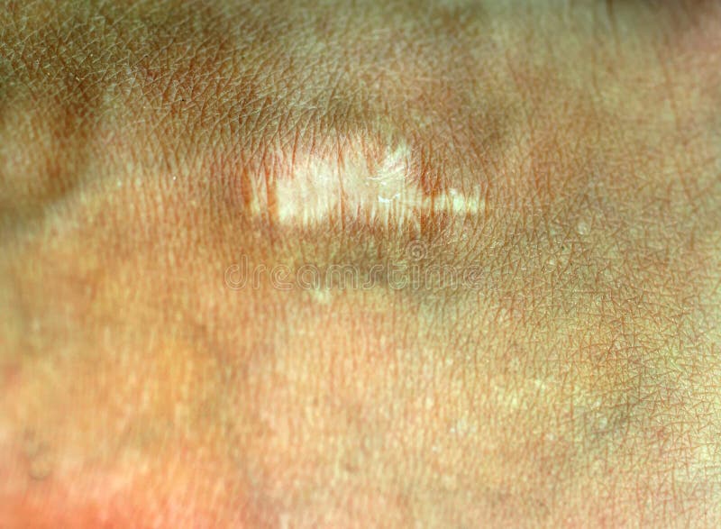 Kruste Auf Der Haut Eine Wunde Auf Der Haut Stockfoto - Bild von ...