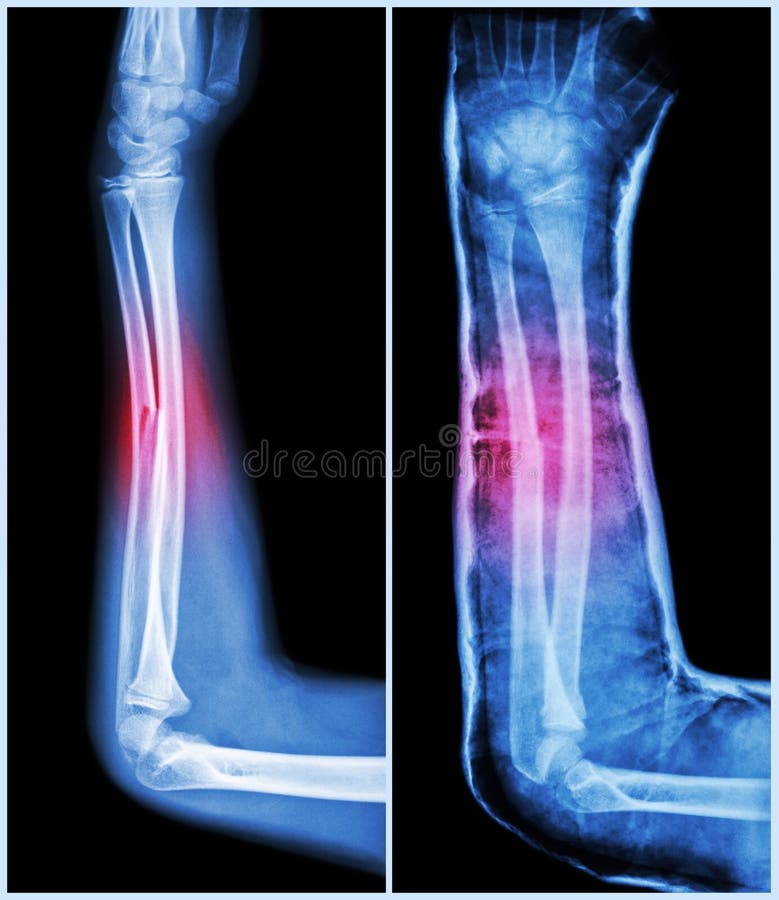 Eixo Da Fratura Do Osso Ulnar Osso Do Antebraço Saido Pré