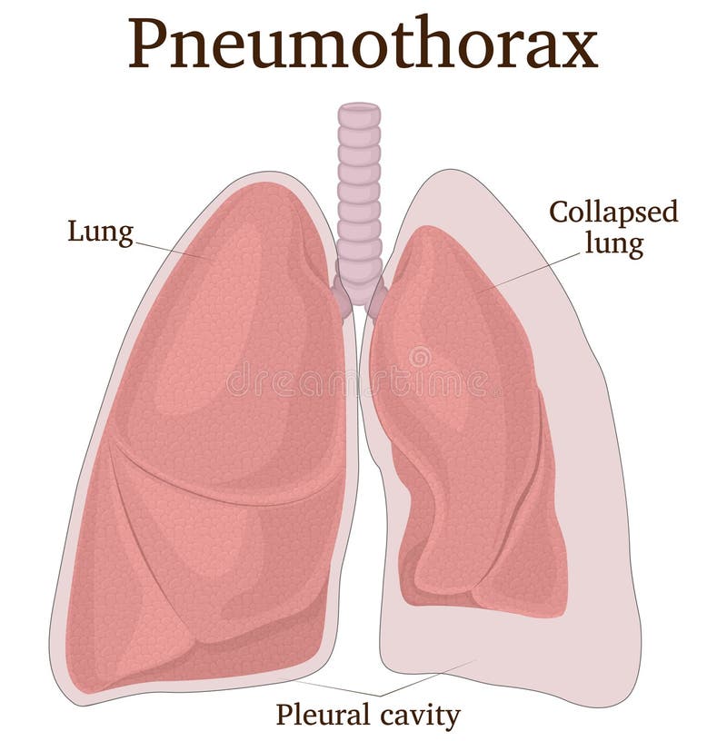 Neumotórax ilustración del vector. Ilustración de pleural - 26701217
