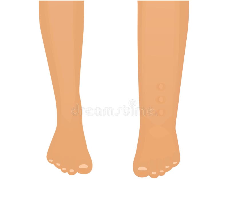 Edema Ilustraciones Stock, Vectores, Y Clipart – (1,677 Ilustraciones ...