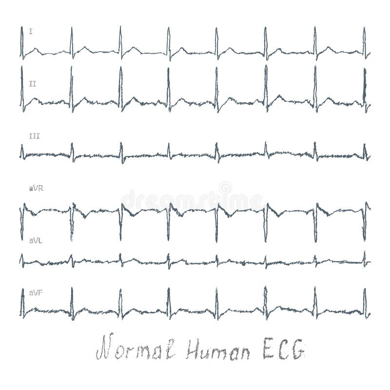 Ejemplo Normal Del Ser Humano De ECG Stock de ilustración - Ilustración ...