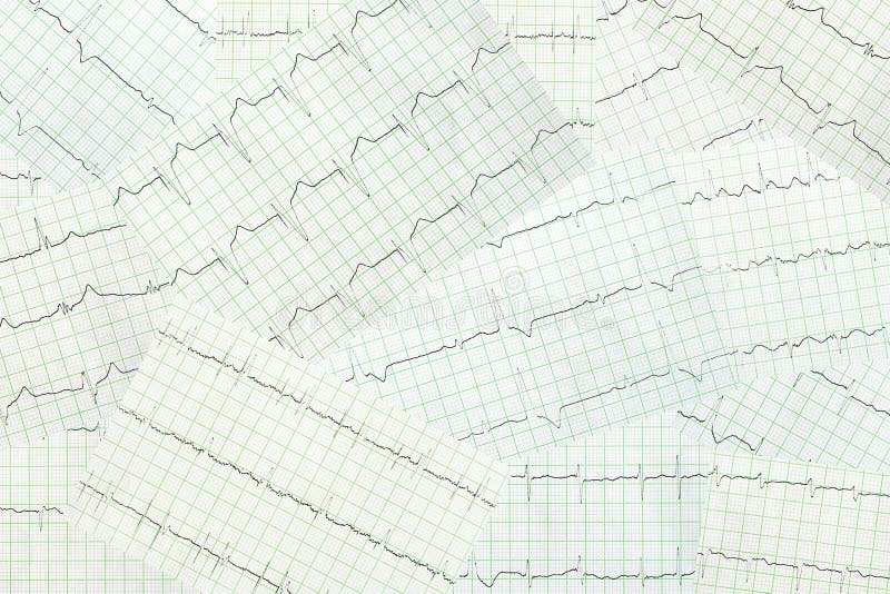 Ekg stockfoto. Bild von obacht, diagnose, diagnostizieren - 13508474