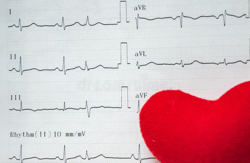 EKG Analysis Paper Showing Abnormal EKG of the Patients in Hospital ...