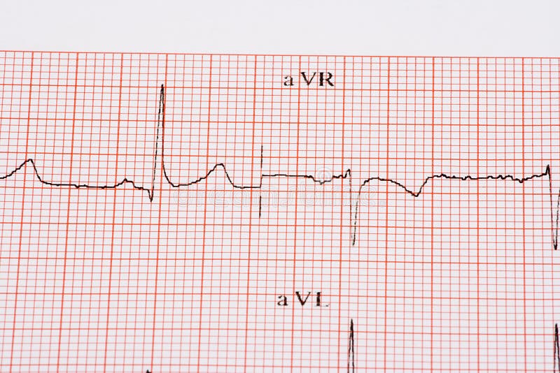 Ecg Chart