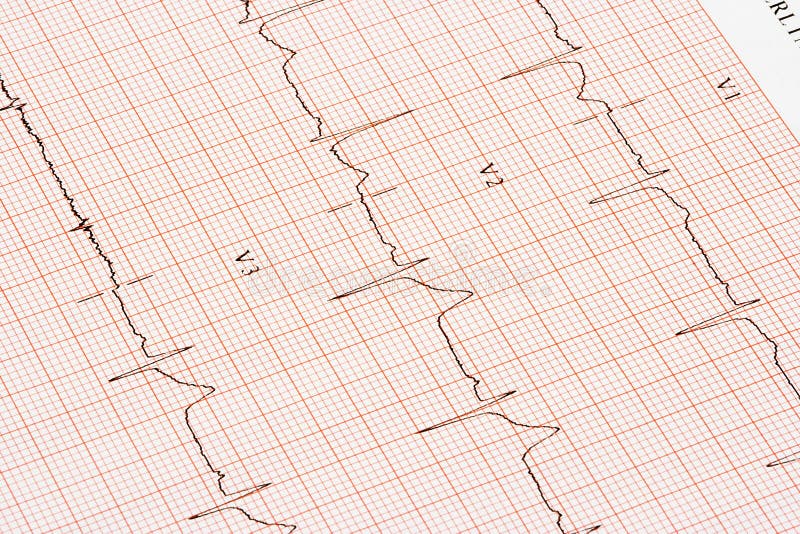 EKG Chart Picture. Image: 3638039