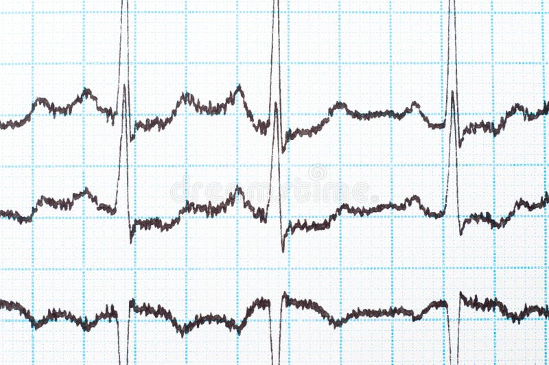 Ekg Diagramm Stockfotos und Bilder - Laden Sie 607 lizenzfreie Fotos ...