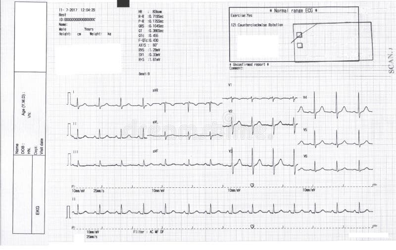 EKG, Ecg Graph, Electrocardiogram Ecg on Paper Stock Photo - Image of ...
