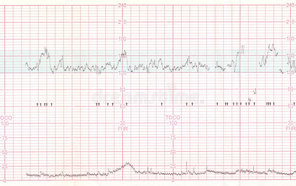EKG or ECG result stock photo. Image of healthcare, background - 42053874