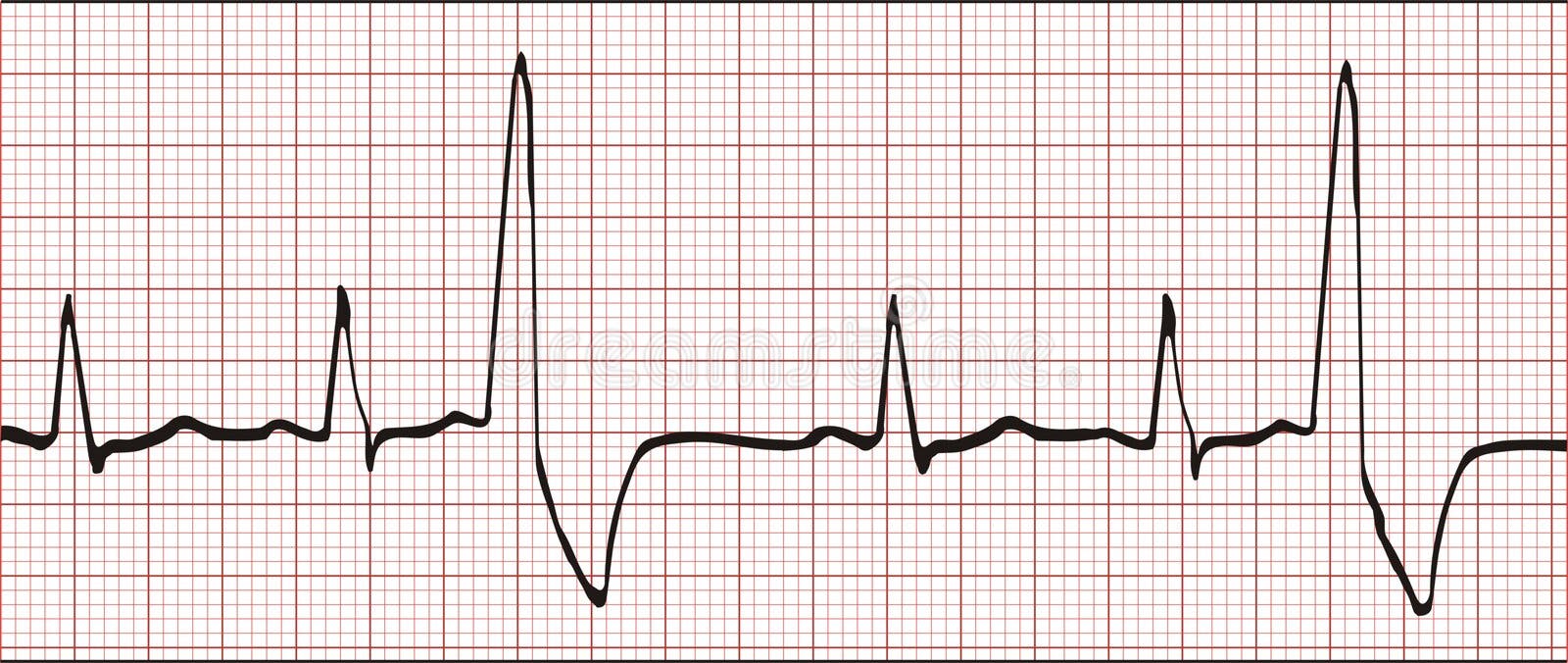 Medicine - Deadly Heart Arrhythmia - VT & VF Stock Illustration ...