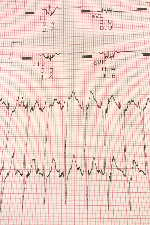 EKG Electrocardiology Diagramm Stockfoto - Bild von bildschirmanzeige ...