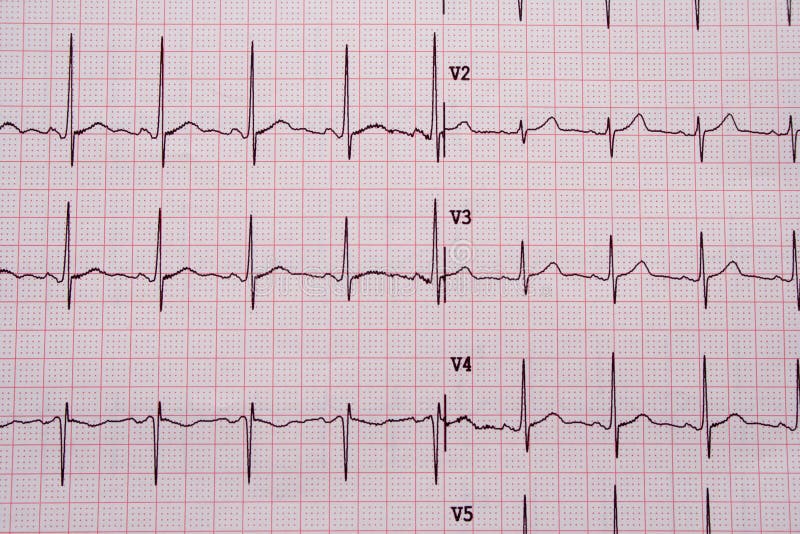 EKG results stock image. Image of diagnosis, beat, checkup - 1438789