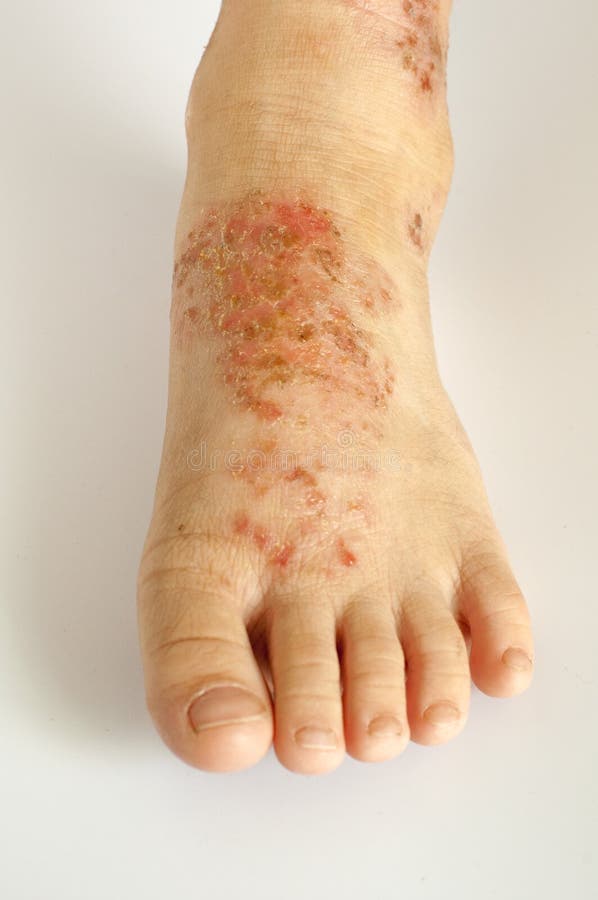 Eksem arkivfoto. Bild av stängning, hälsa, läkarundersökning - 55747732