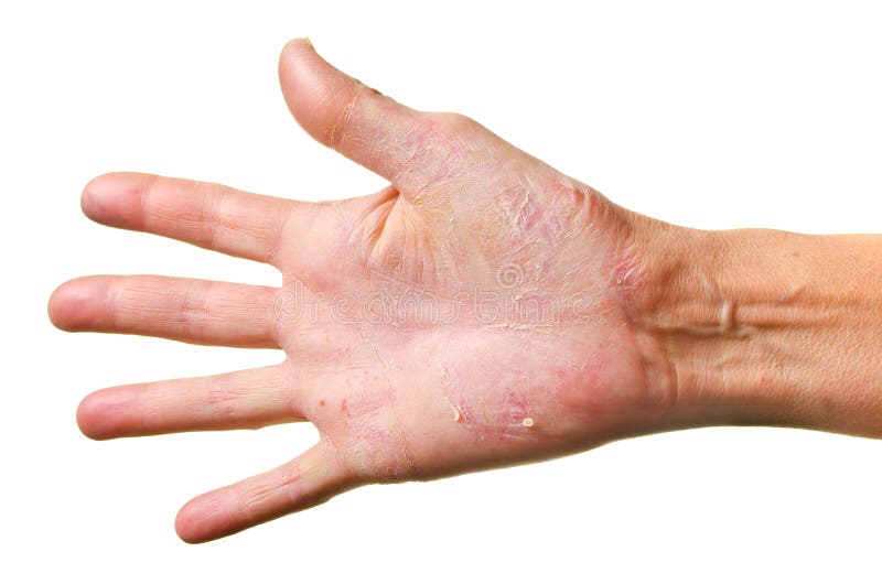 Hand Mit Dyshidrotic Ekzem Der Interdigitalen Dermatitis an Hand Eng ...