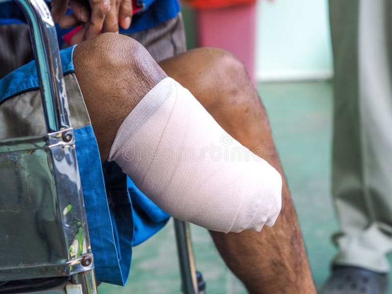 Elastic Bandaged Below Knee Amputation Stock Image - Image of disabled ...