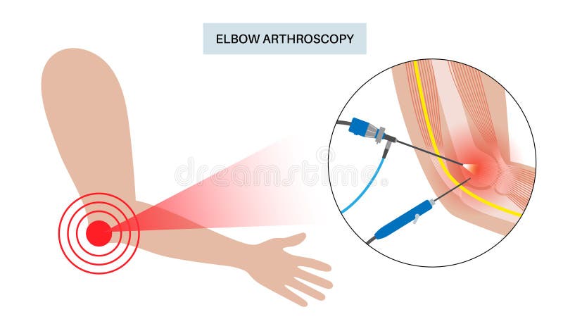 Elbow arthroscopy surgery stock vector. Illustration of keyhole - 291286133