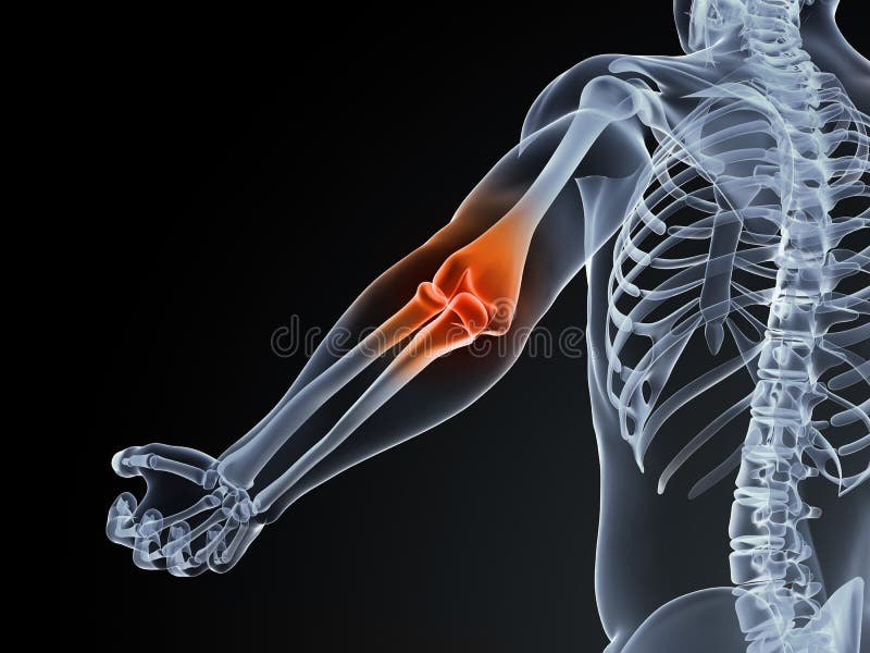 Elbow bursitis stock illustration. Illustration of elbow - 19356349