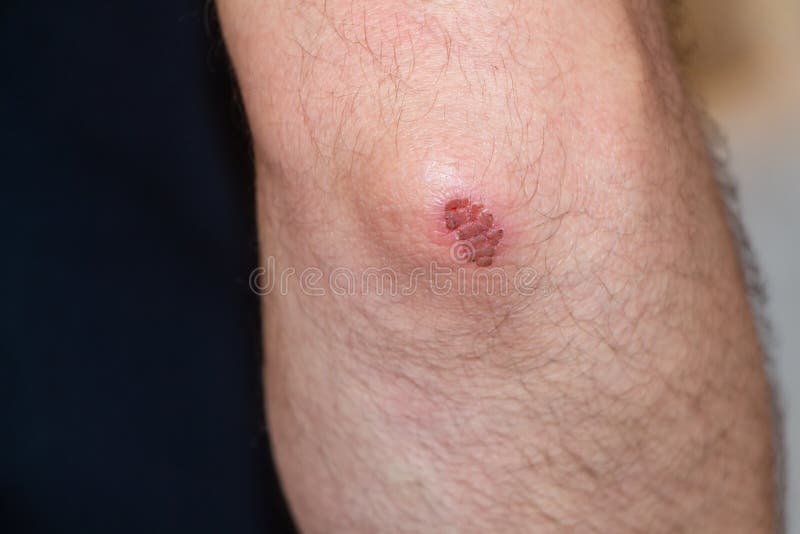 Graze Wound Stock Photos - Free & Royalty-Free Stock Photos from Dreamstime