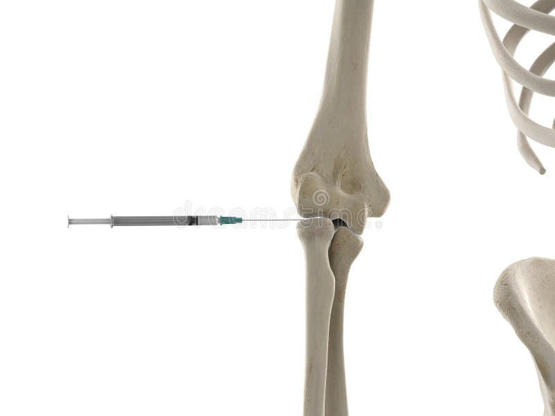 An elbow injection stock illustration. Illustration of accurate - 169373965