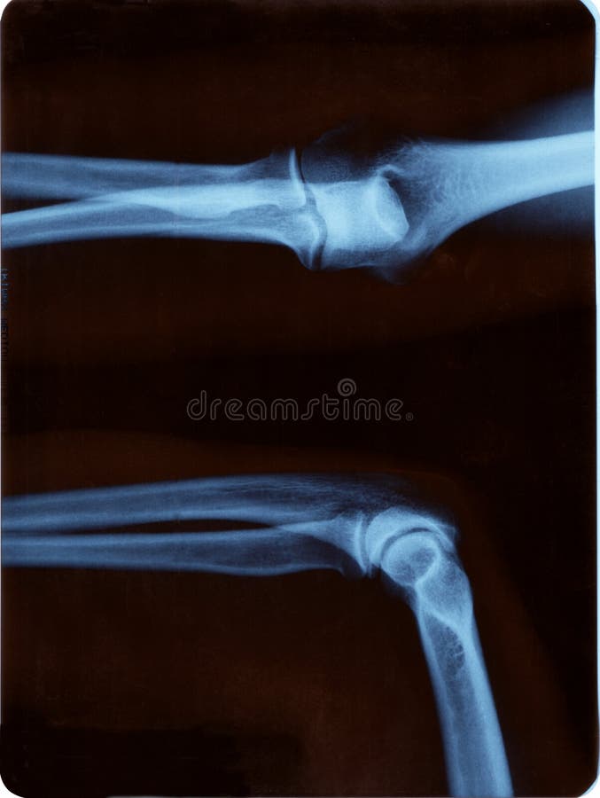 Film X-ray Elbow AP(Antero-posterior)/lateral Stock Image - Image of ...