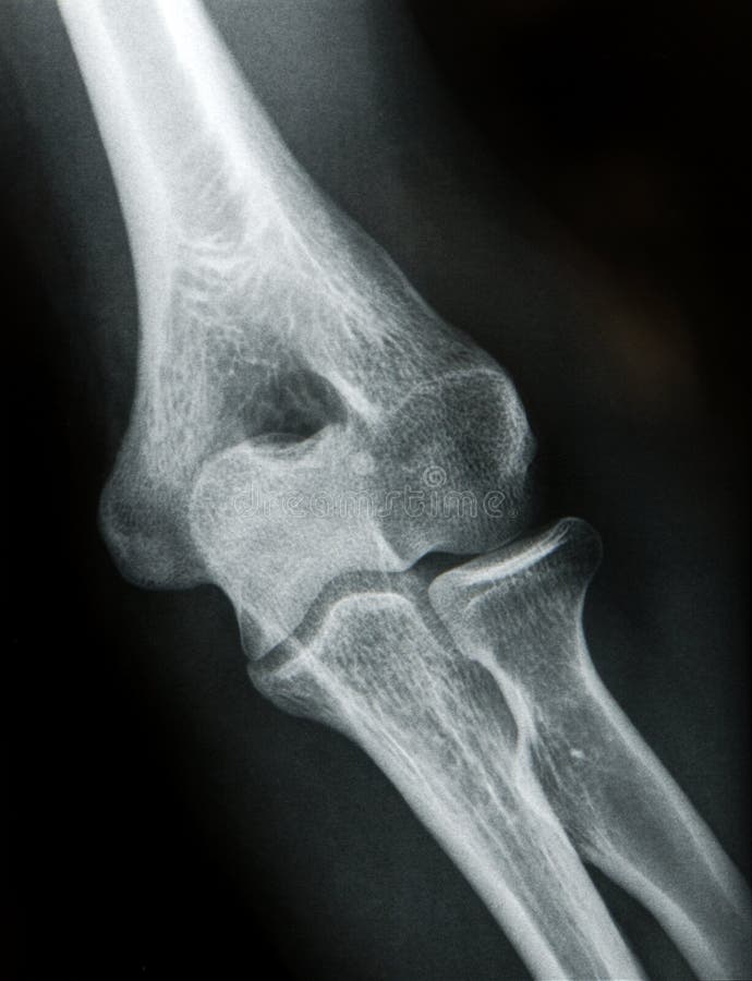 Elbow radiography stock image. Image of care, exam, human - 4790263