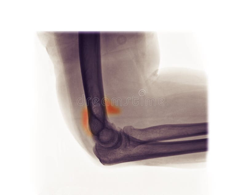 Fat Man Xray Stock Photos - Free & Royalty-Free Stock Photos from ...