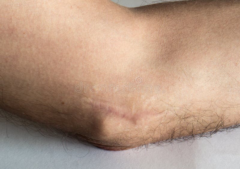 Elbow with scar stock image. Image of surgery, injury - 165863629
