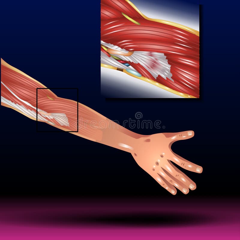 Elbow, Elbow Tendonitis, Elbow Dislocation, Elbow Bone Illustration ...