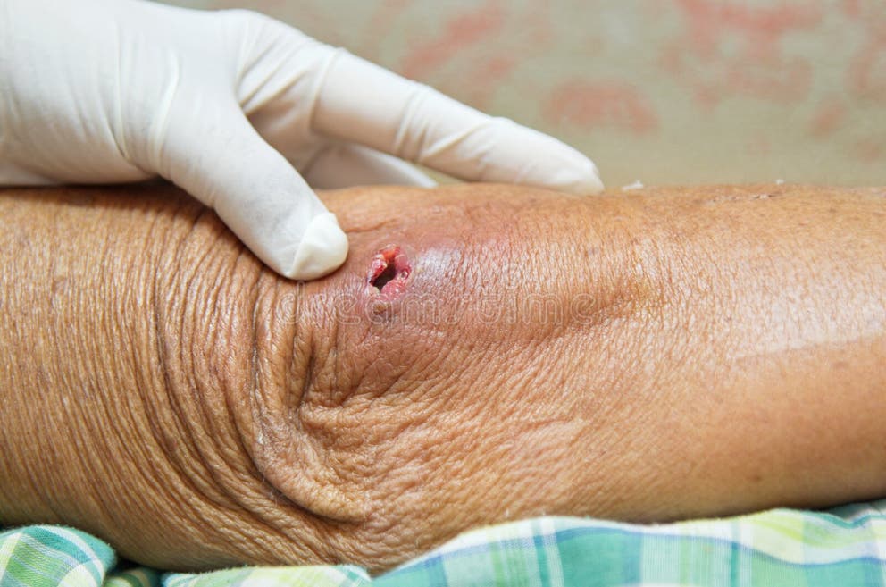 Elbow was abscess. stock image. Image of patient, hole - 63785919