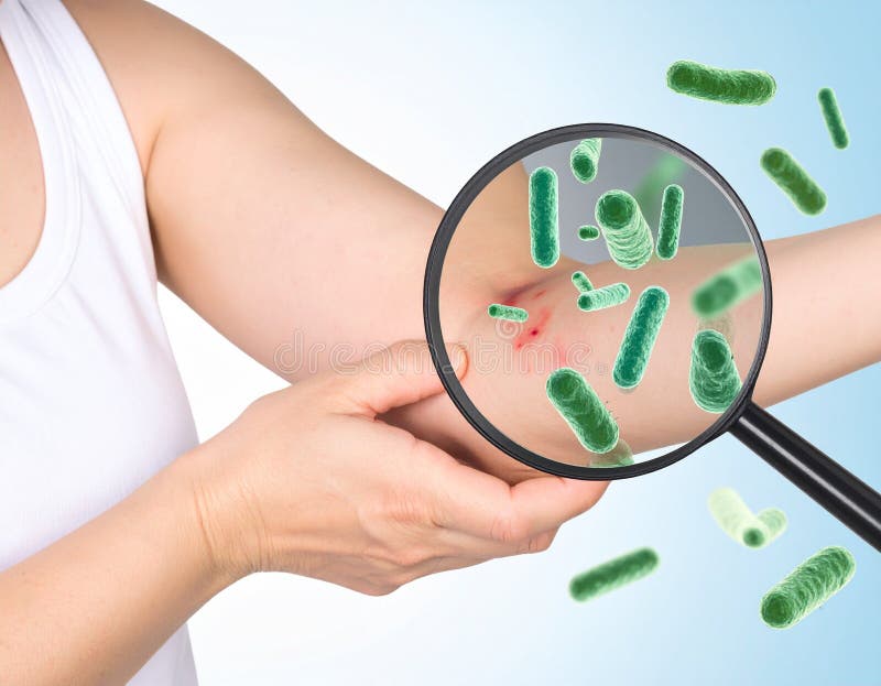 An Elbow Wound Visibly Surrounded by Infection-causing Bacteria ...