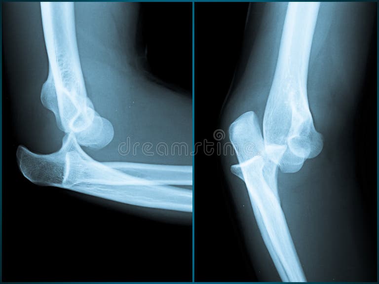 350 Real Elbow Stock Photos - Free & Royalty-Free Stock Photos from ...