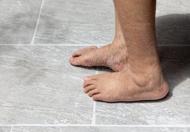 Elderly Woman Feet Have Varicose Veins Stock Image Image Of Stand