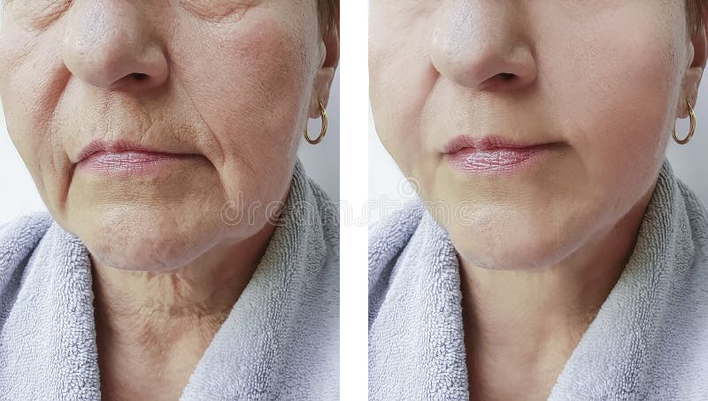 Elderly Woman Wrinkles Face before and after Procedures, Effect Stock ...