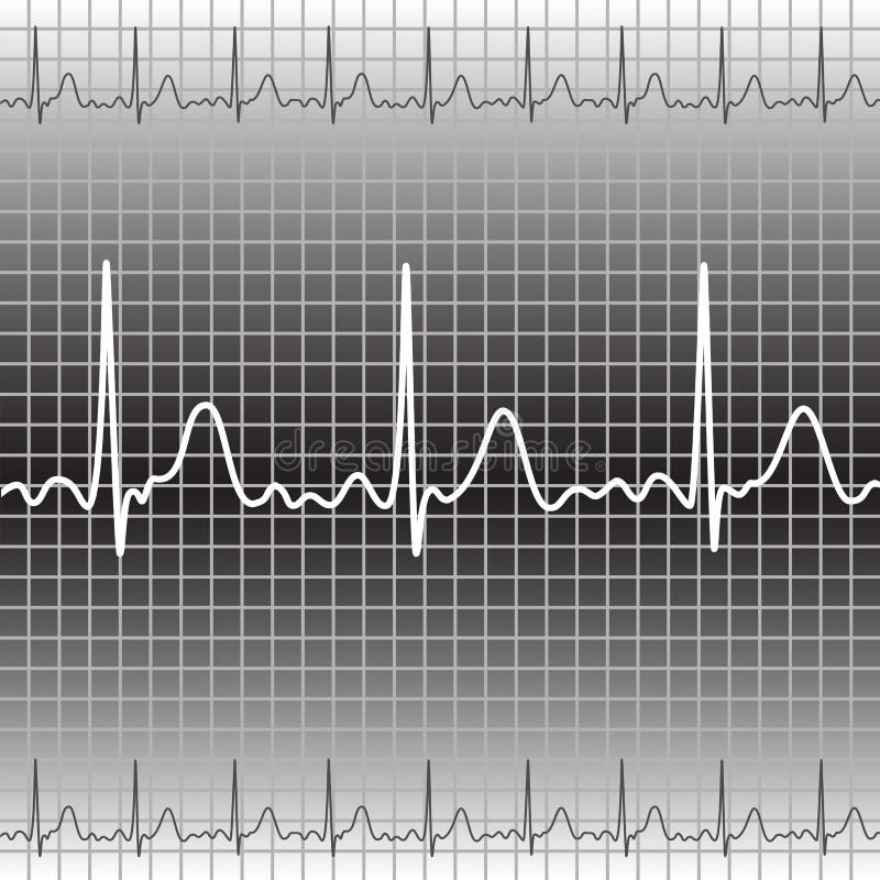 Heart Normal Sinus Rhythm on Electrocardiogram Stock Vector ...