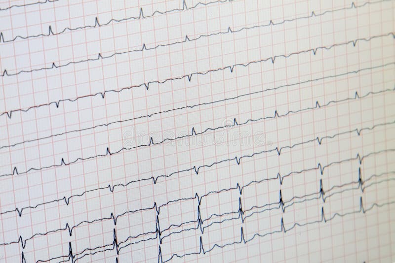 Electrocardiogram (ecg stock image. Image of diagnosis - 216392537