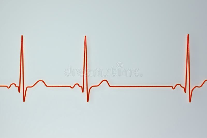 Electrocardiogram ECG Displaying Ventricular Fibrillation Rhythm, 3D ...