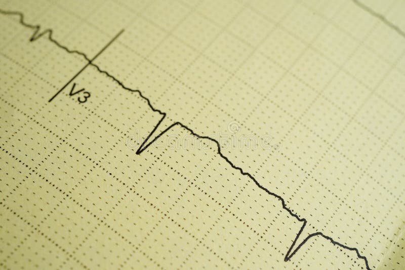 Electrocardiogram (ECG), Heart Wave, Heart Attack, Cardiogram Report ...