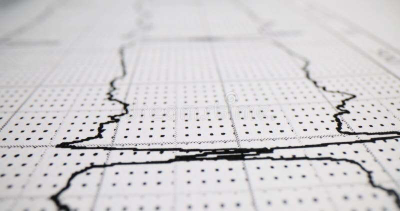 Electrocardiogram ECG and Recording the Electrical Activity of Heart ...