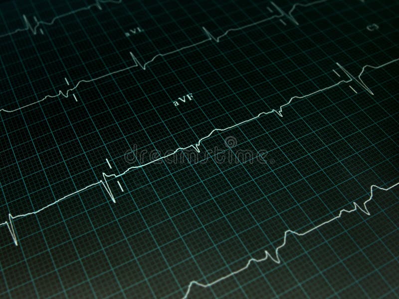 Electrocardiogram ECG in a Graph Paper Shows Normal Sinus Rhythm, Vital ...