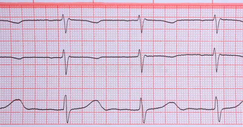 Electrocardiogram Graph Displaying Heartbeats on Grid Paper. Stock ...