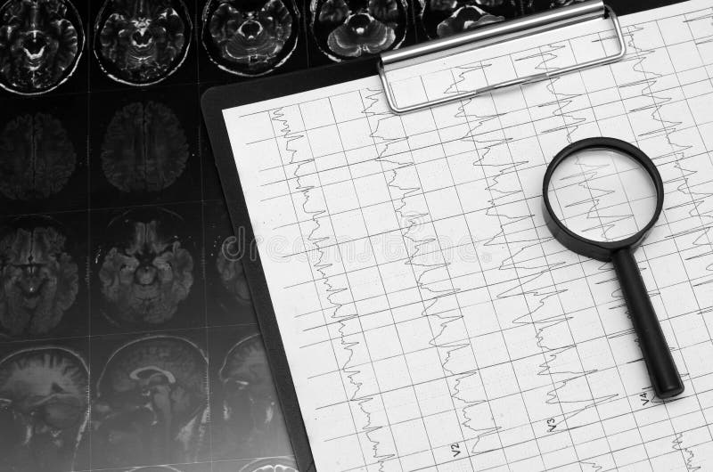 Electrocardiogram Graph ECG, Heart Analysis. Black Clipboard Stock ...