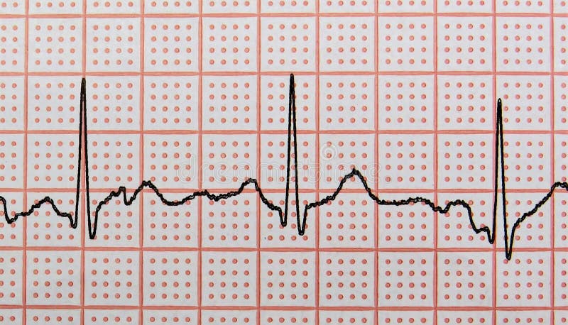 Electrocardiogram with the Heartbeat Stock Image - Image of curve ...