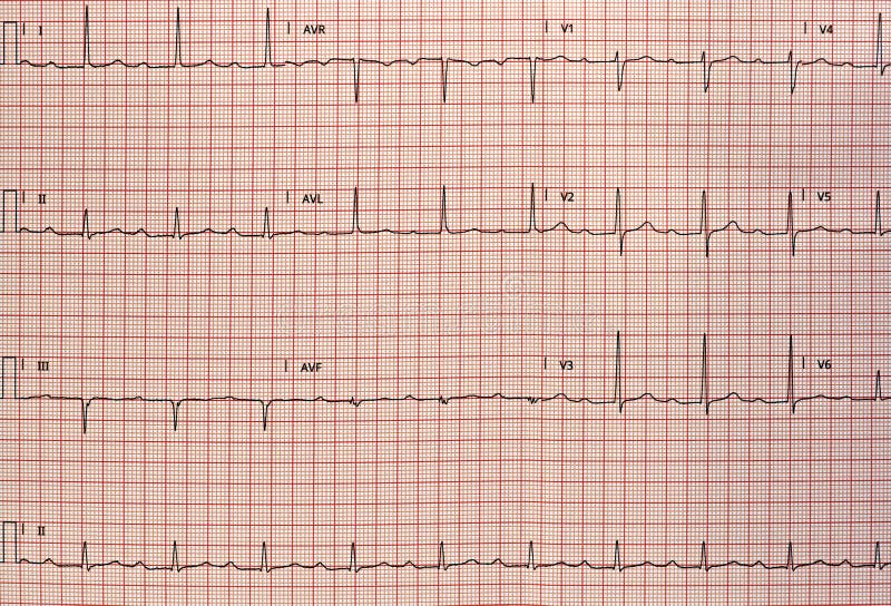 Electrocardiogram in Paper Form. Analog Electrocardiographic Recording ...