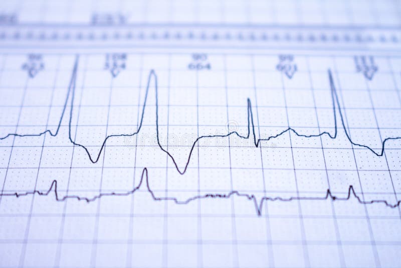 Electrocardiogram Recorded on Graph Paper. Study of the Human Heart ...
