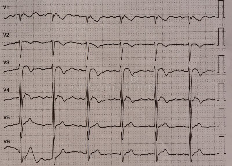 Electrocardiogram Showing Heart Rhythm Patterns Suggestive Myocardial ...